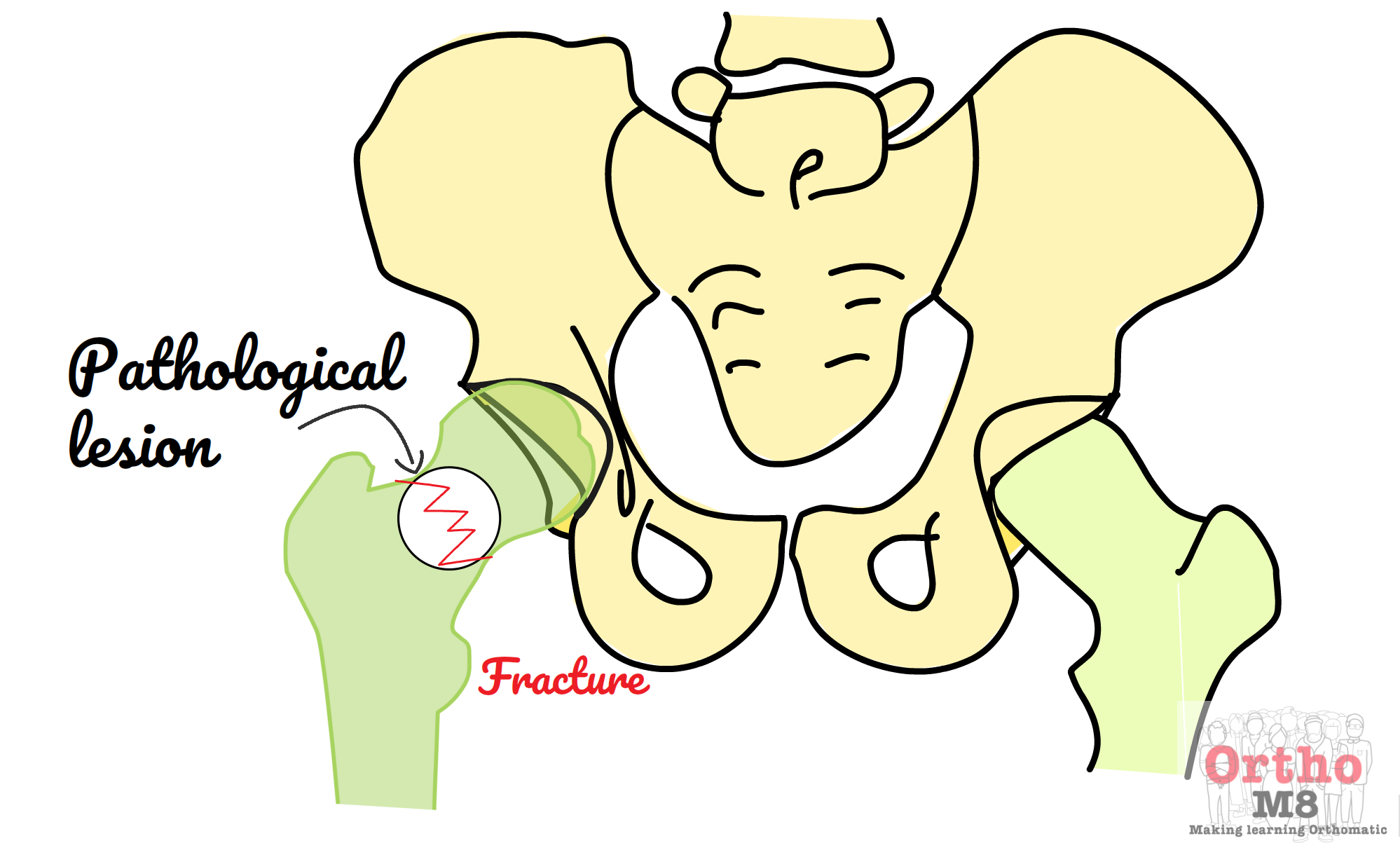 Pathological fractures of the hip