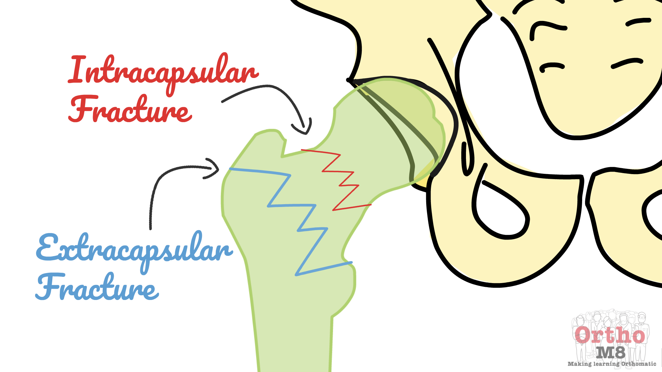 Classification of hip fractures